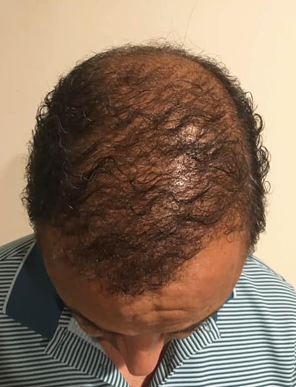 Does Minoxidil Work for Hair Loss? - Best Hair Transplant