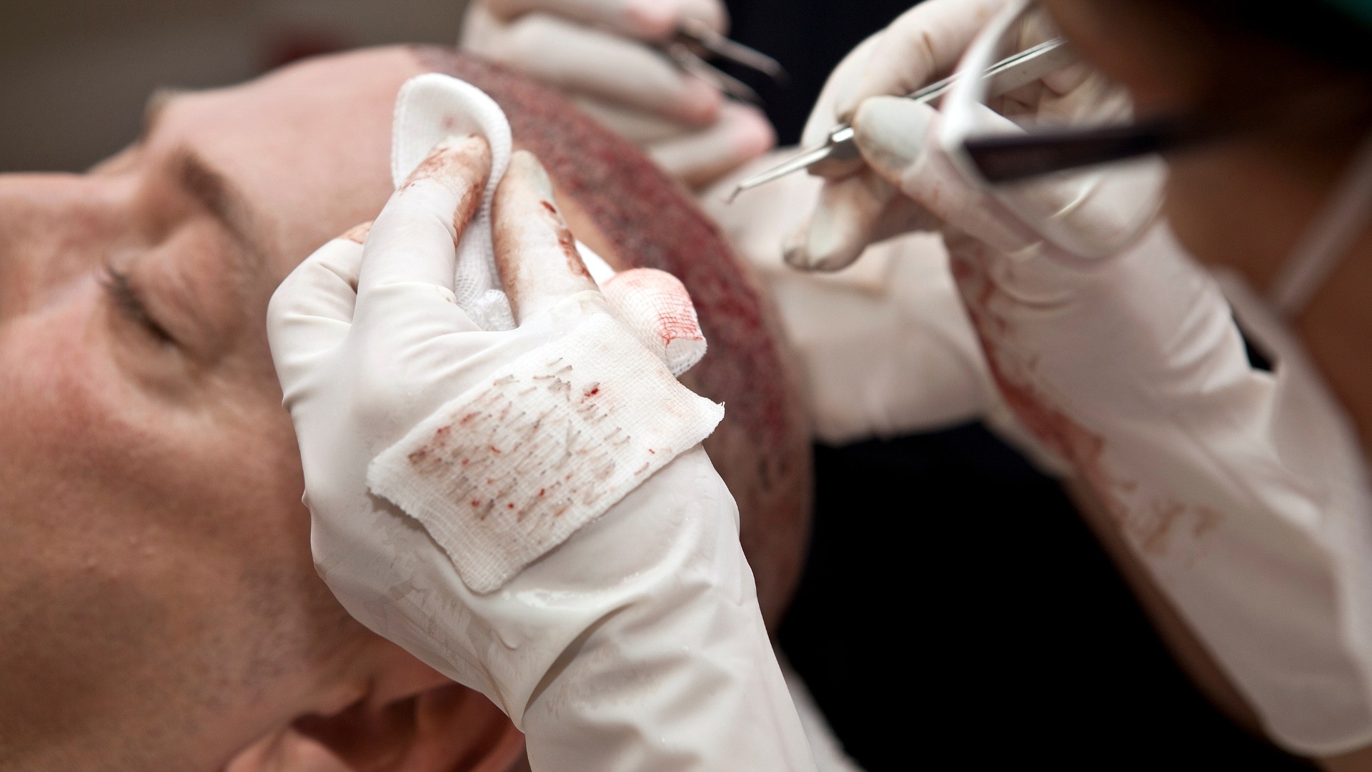 Expert Guide to Turkish Hair Transplant Repair for Optimal Results